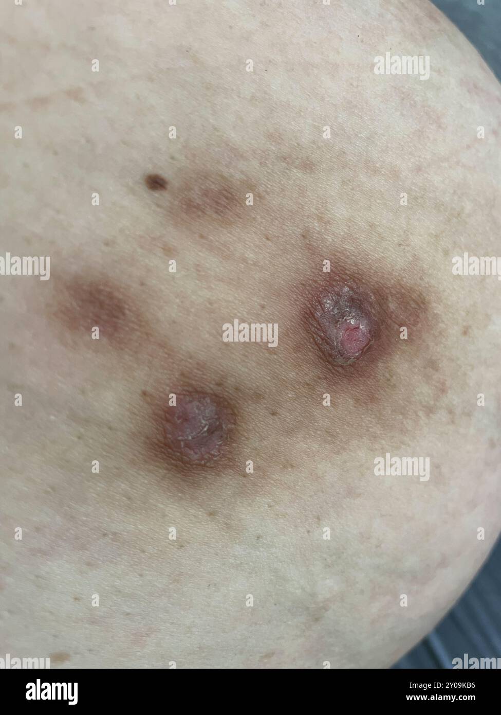 Entzündliche Veränderungen Pusteln, Ausschlag auf der Haut Stock Photo ...