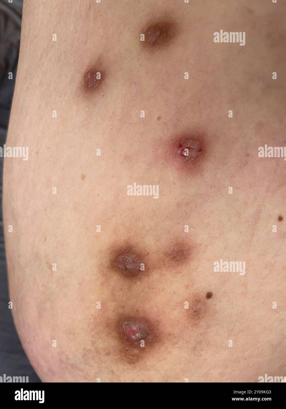 Entzündliche Veränderungen Pusteln, Ausschlag auf der Haut Stock Photo ...