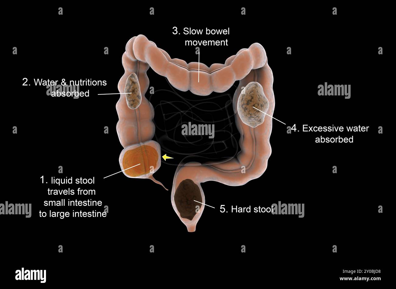 Medical diagram illustrating constipation in the human intestines Stock ...