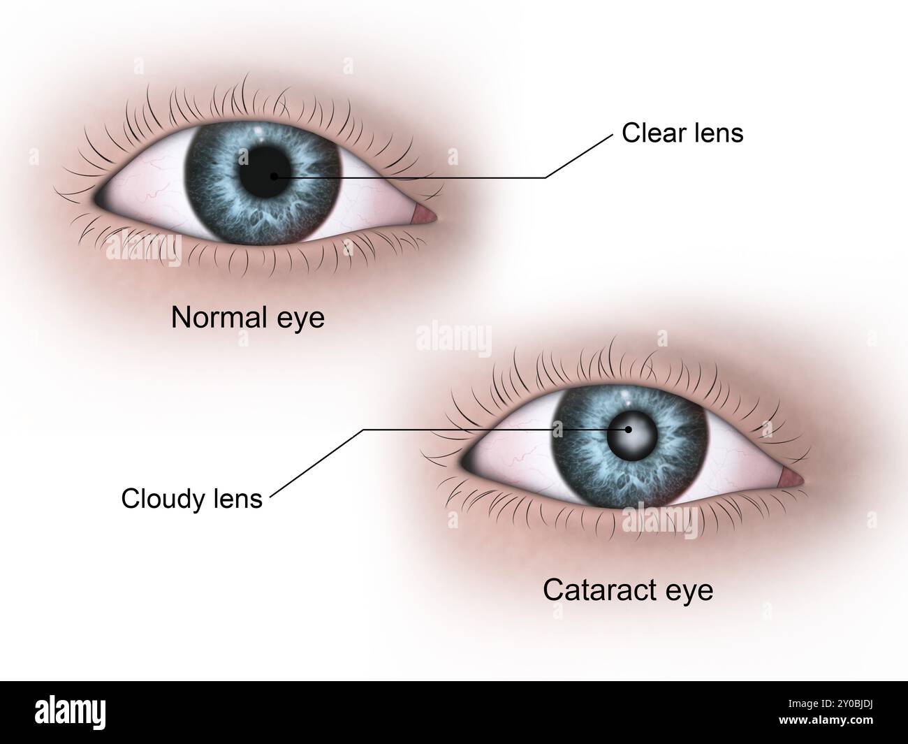 Normal Eyes Vs Cataract Surgery Connecticut | Cataracts Middletown