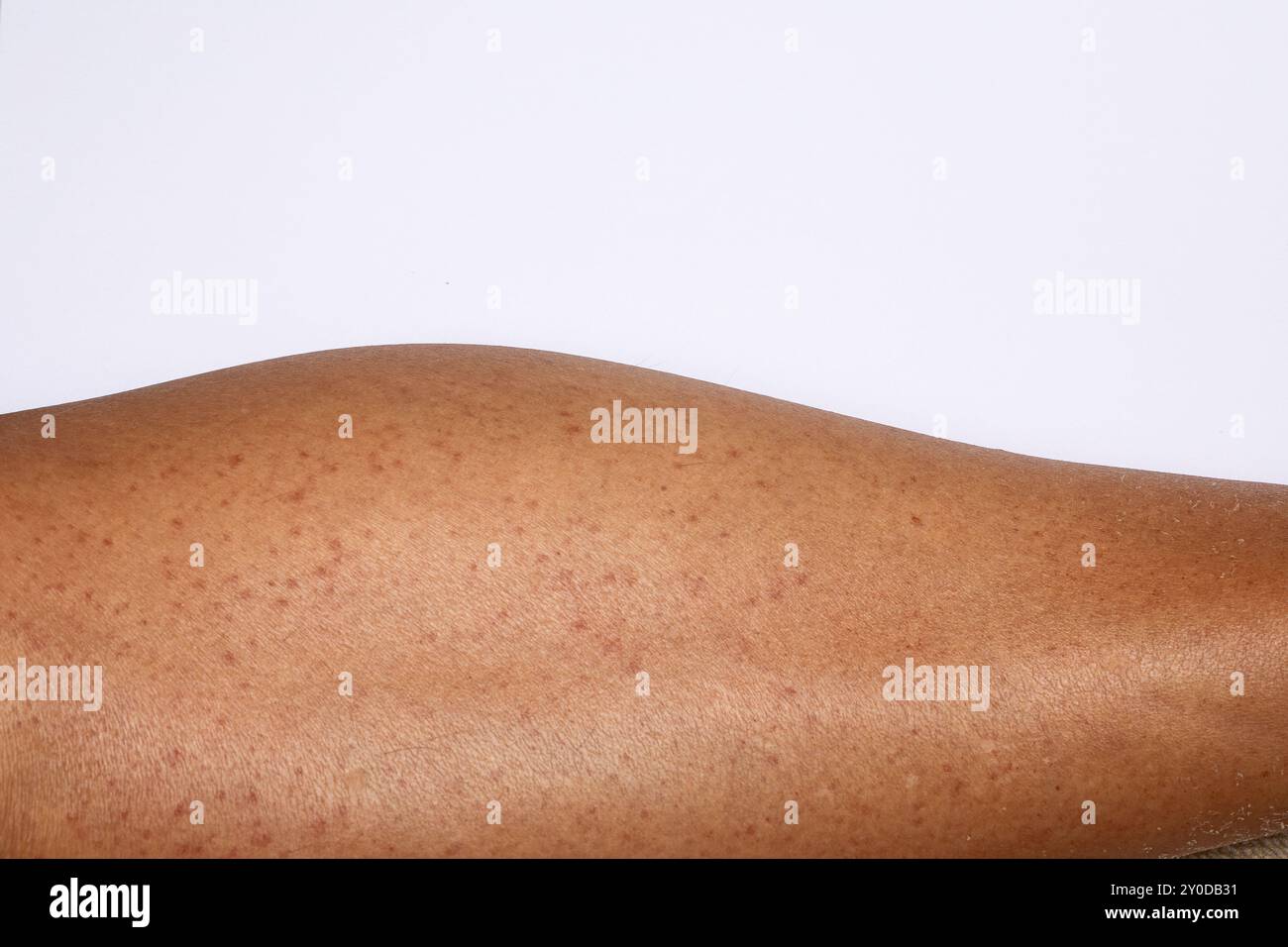 Close up of someone's dry skin, showing follicles, red spots, and other ...