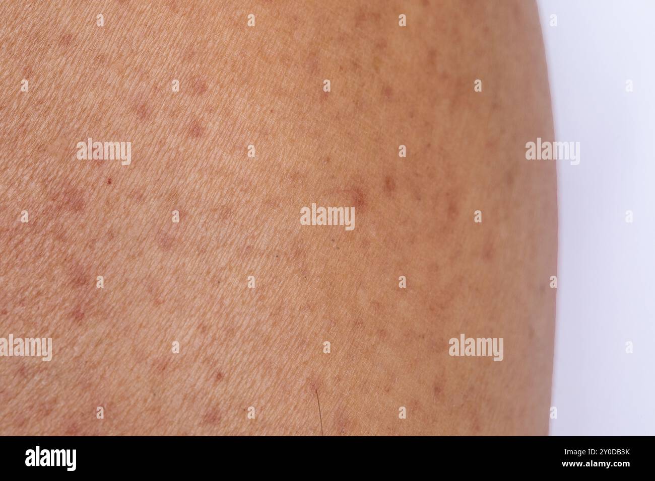 Skin presenting symptoms of eczema dermatitis, a common inflammatory ...