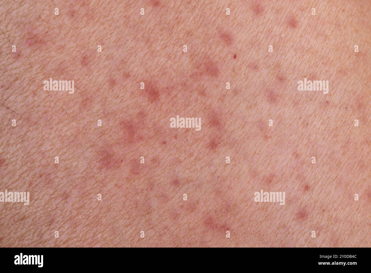 Red spots covering human skin, suffering from chronic skin disease ...