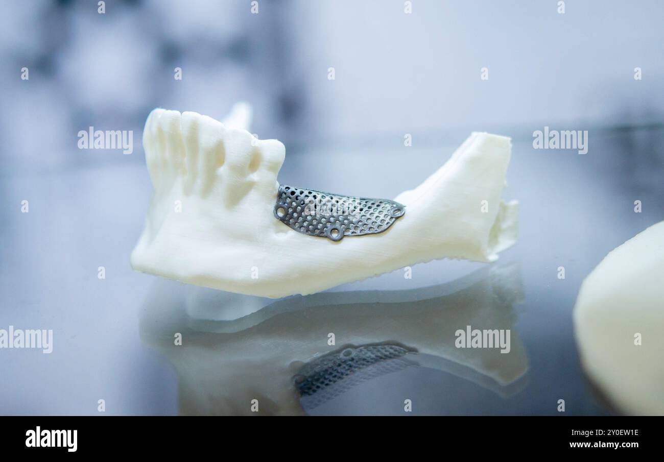 Prototype of lower human jaw with medical titanium implant from ...