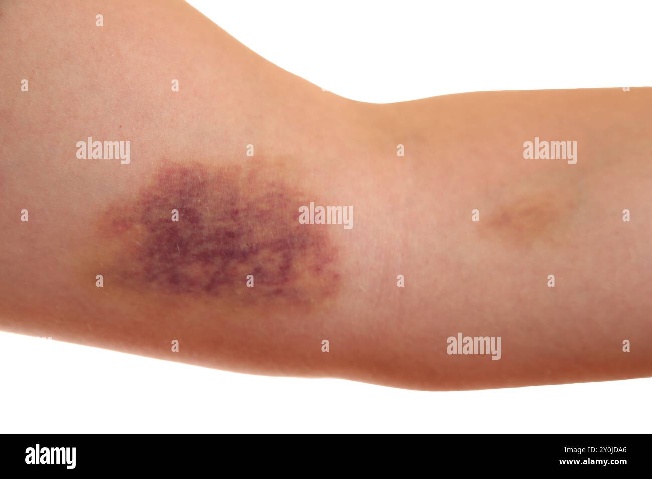 Woman with bruise on arm against white background, closeup Stock Photo ...