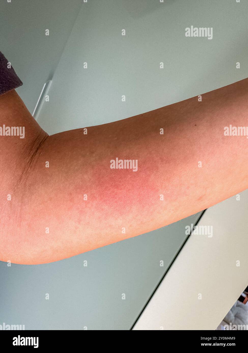 female arm with red swollen spot from an ant bite . High quality photo ...