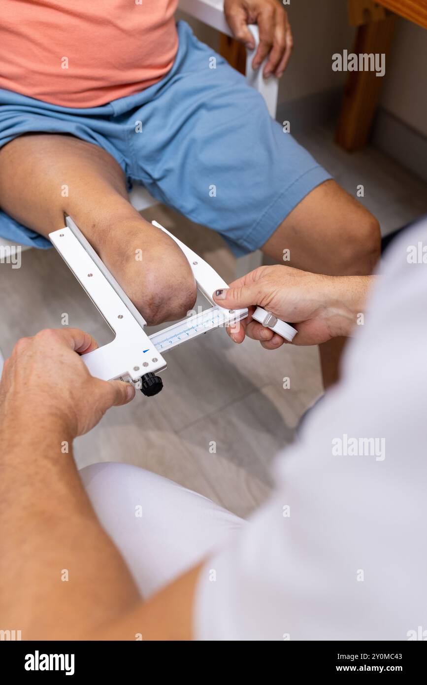 Measuring leg for prosthetic fitting, technician using caliper on ...
