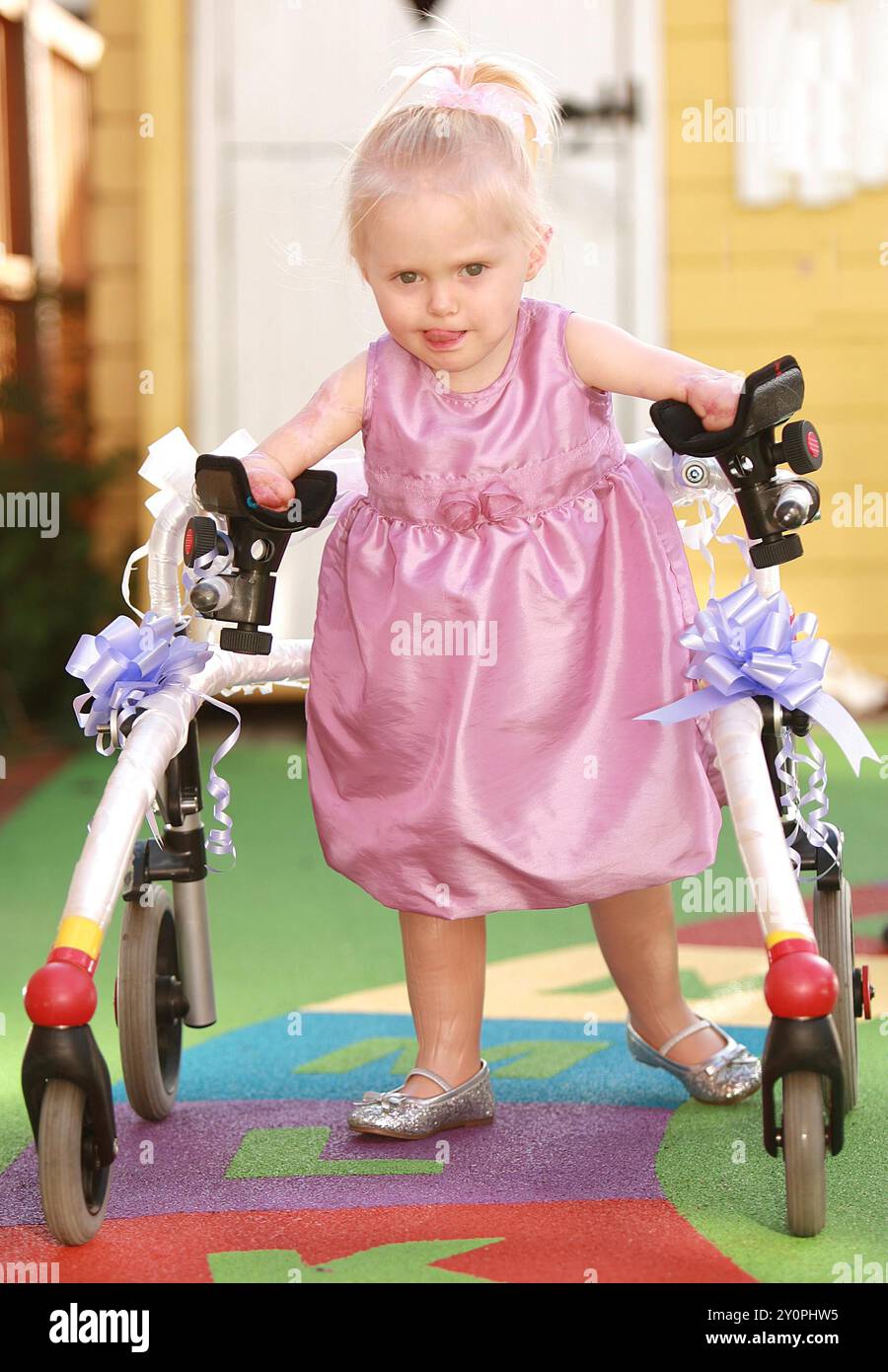 ELLIE CHALLIS TAKING HER FIRST STEPS, WEARING HER NEW LEGS. Ellie ...