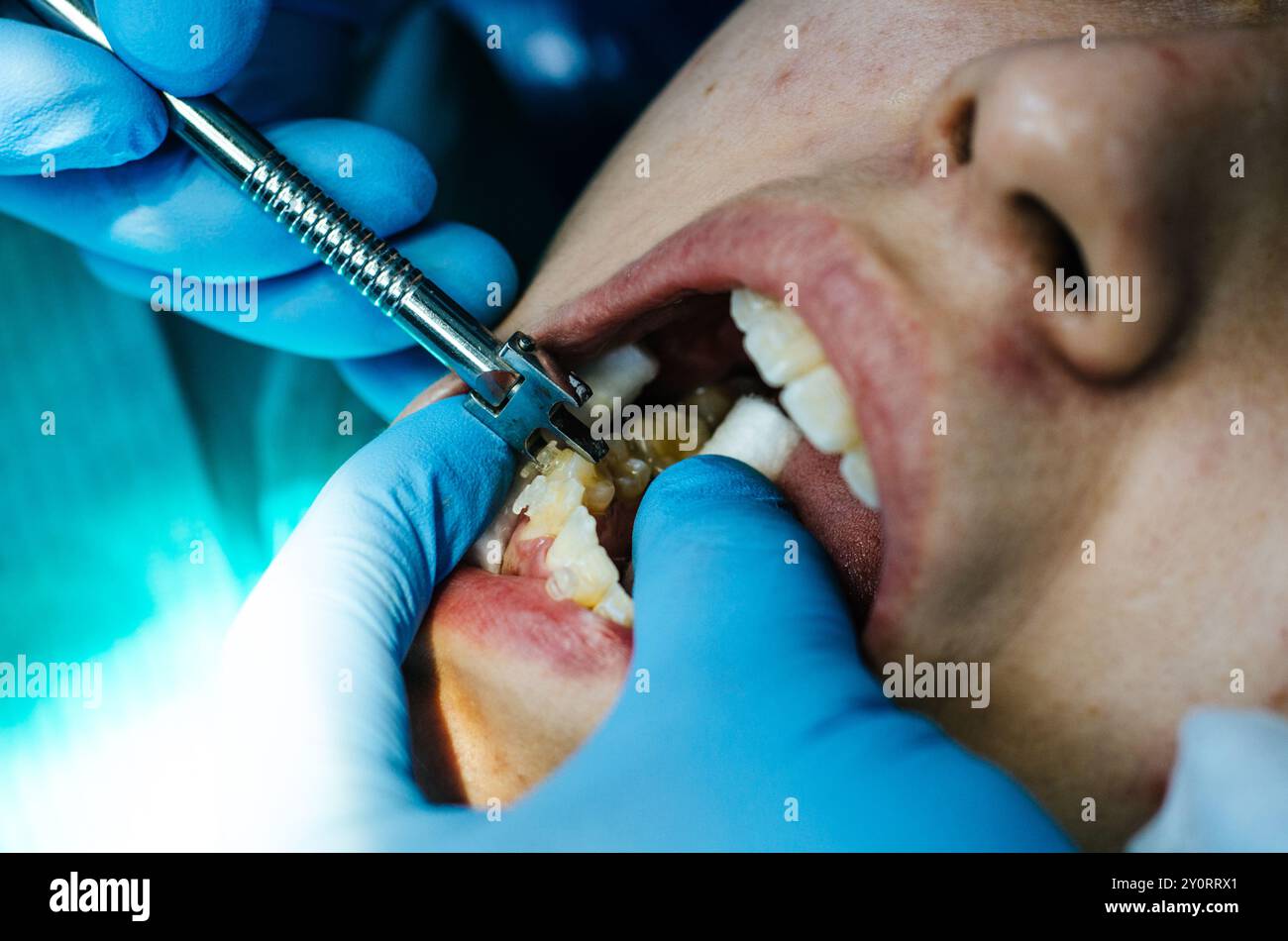 Dentist checking up teeth with ceramic brackets using dental tools ...