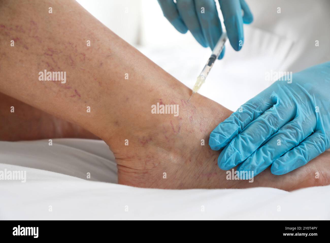 Varicose veins treatment. Doctor giving injection to patient indoors ...