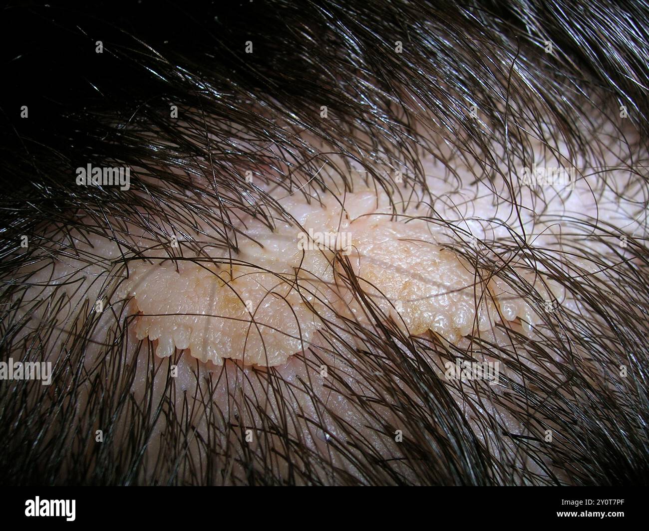 Sebaceous naevus on an adolescent's scalp. This harmless congenital ...