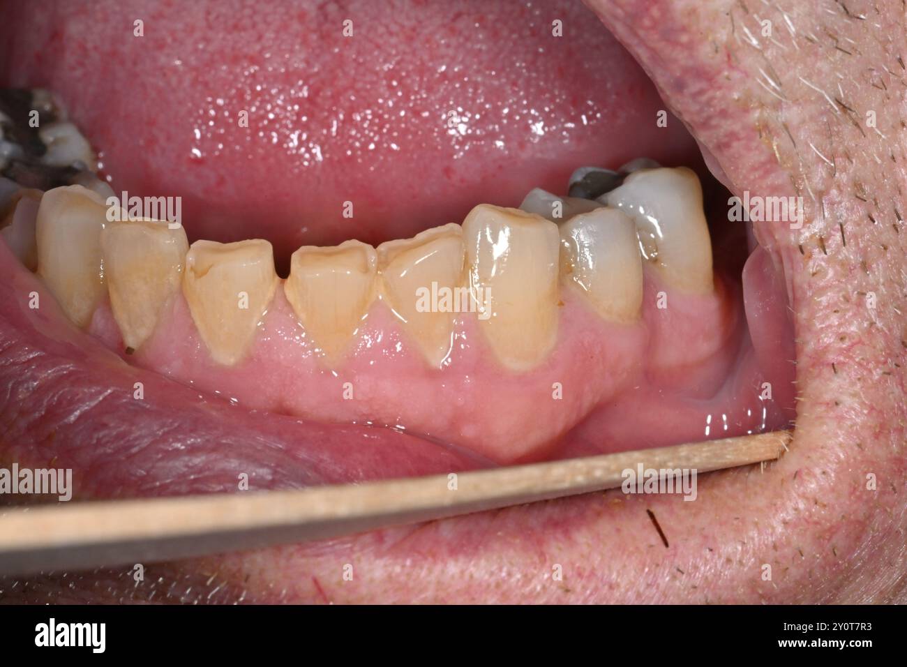 Mild drug-induced gum hyperplasia in a 75 year old male patient ...
