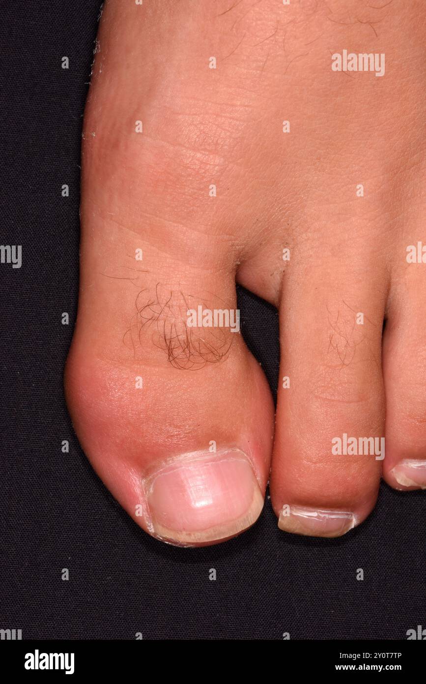Bunion in the big toe of a 16 year old male patient. A hallux valgus ...