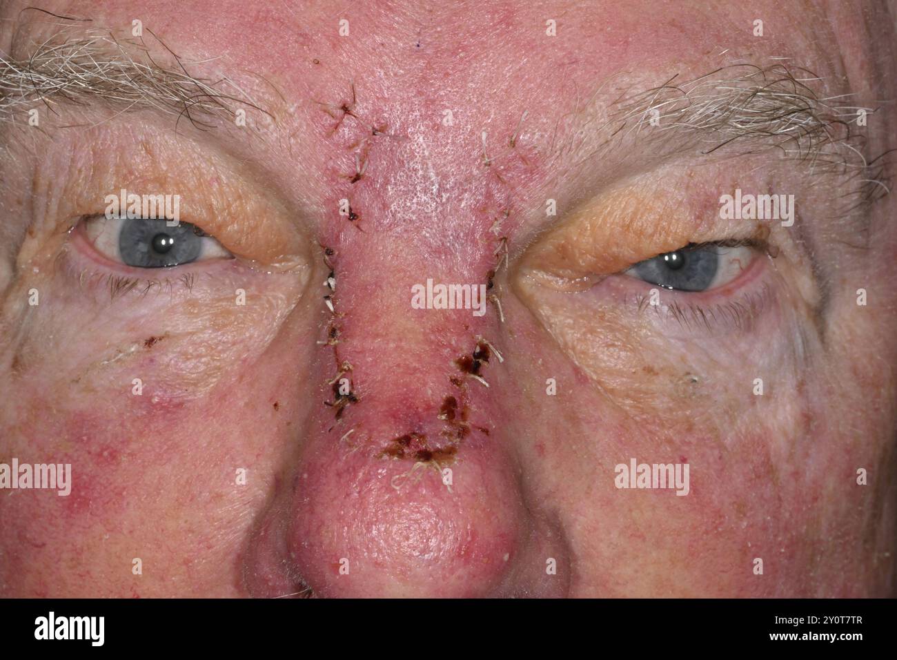Editorial use only 72 year old male patient after an operation to ...