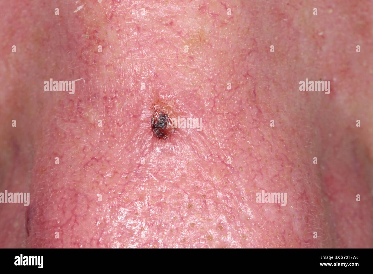 Not to be used for advertising or in a defamatory context Basal cell ...