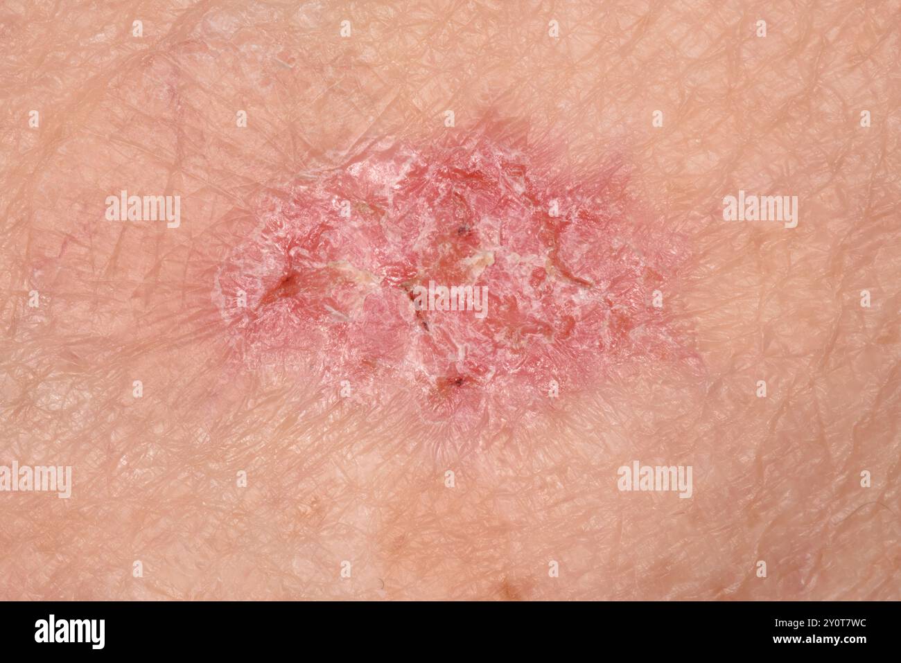 Skin Cancer On Cheek