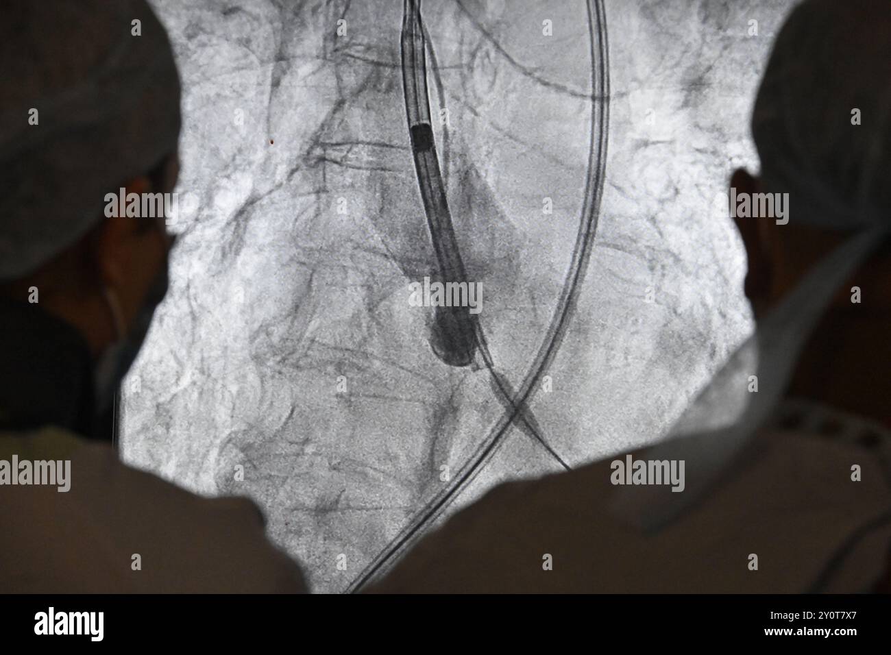 Doctors observing a live X-ray during a transcatheter aortic valve ...