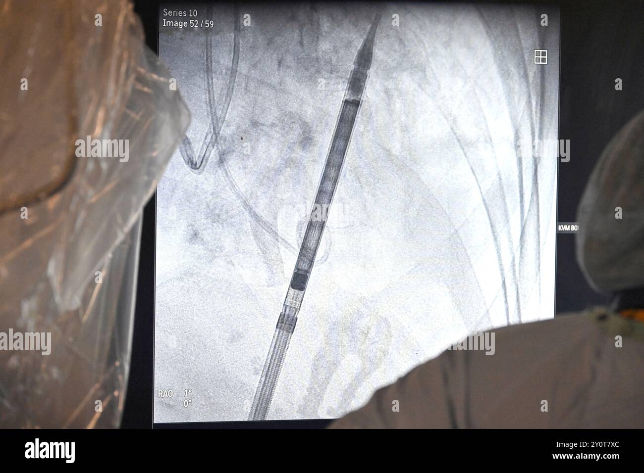 Live X-ray during a transcatheter aortic valve implantation (TAVI ...