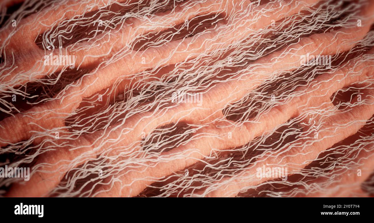 Illustration of human heart tissue affected by amyloid light chain (AL ...