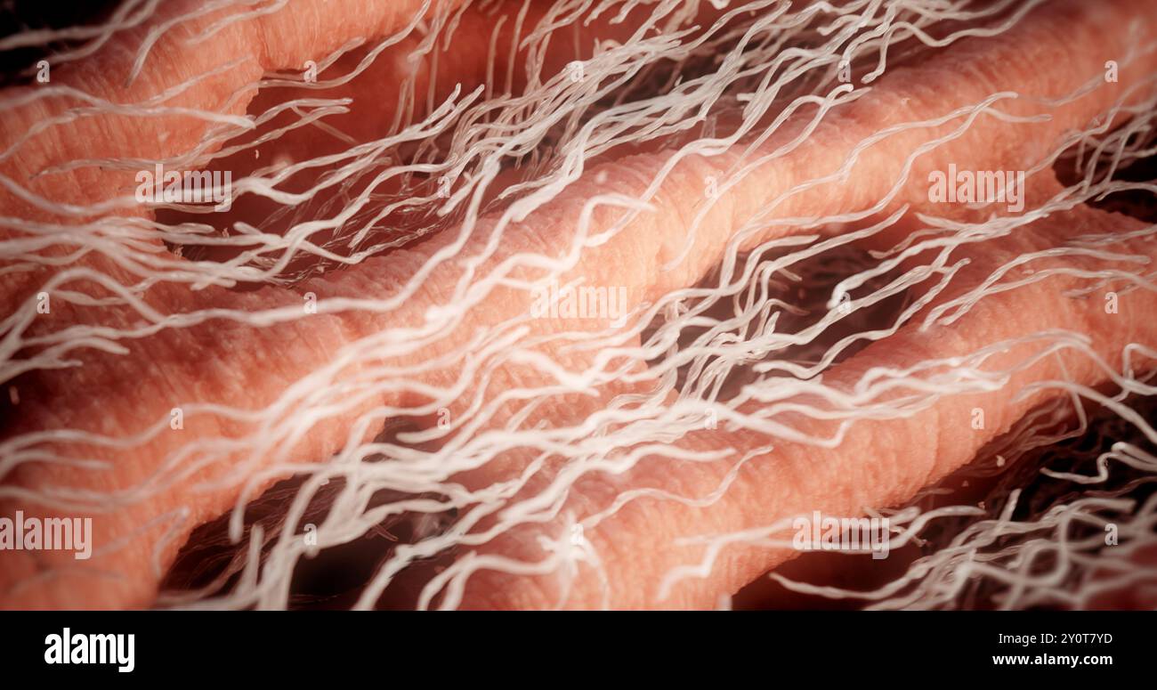 Illustration of human heart tissue affected by amyloid light chain (AL ...