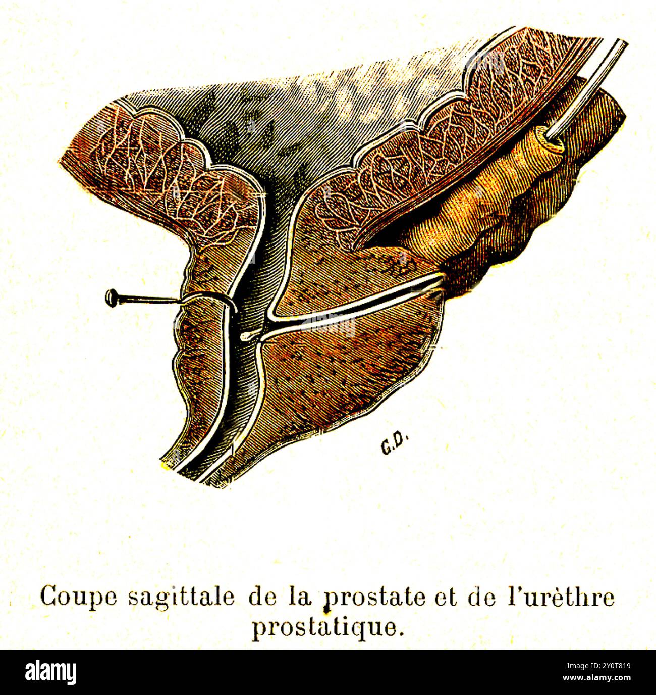 Illustration of a sagittal section through the prostate (right) and the ...