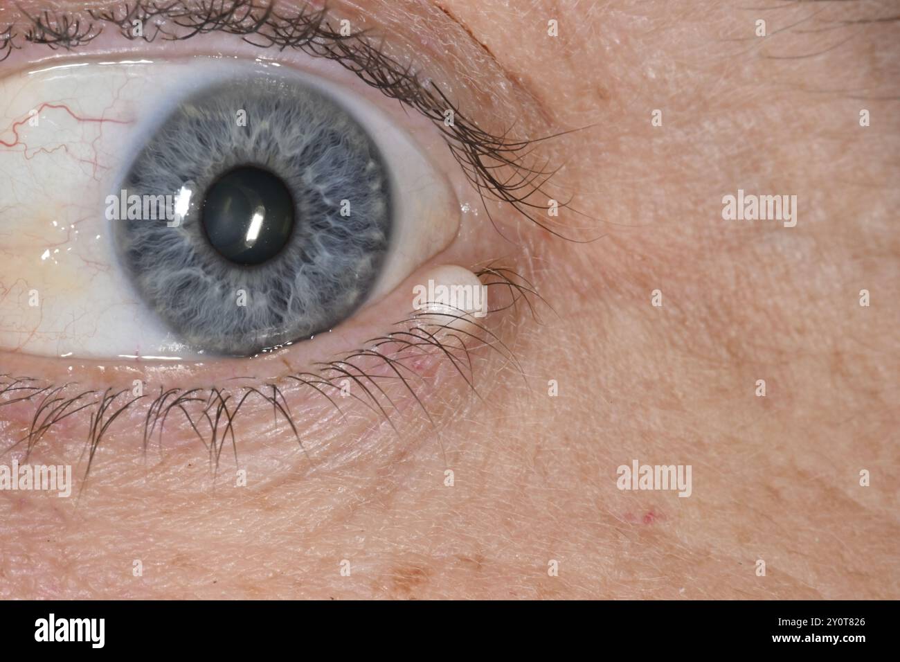 Meibomian cyst, or chalazion, in the lower eyelid of a 56 year old ...