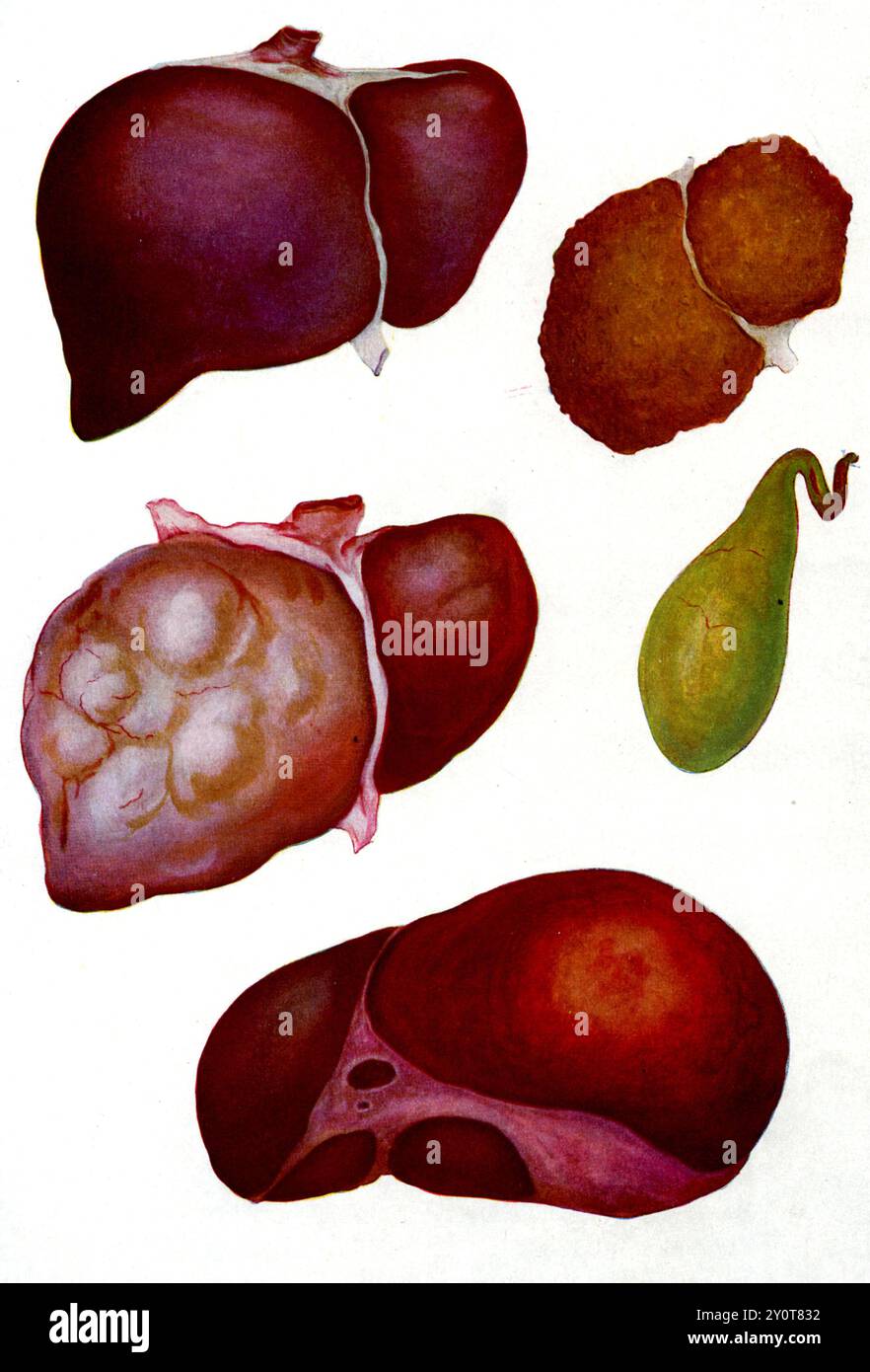 Illustration of a healthy liver (top left) and gallbladder (right ...