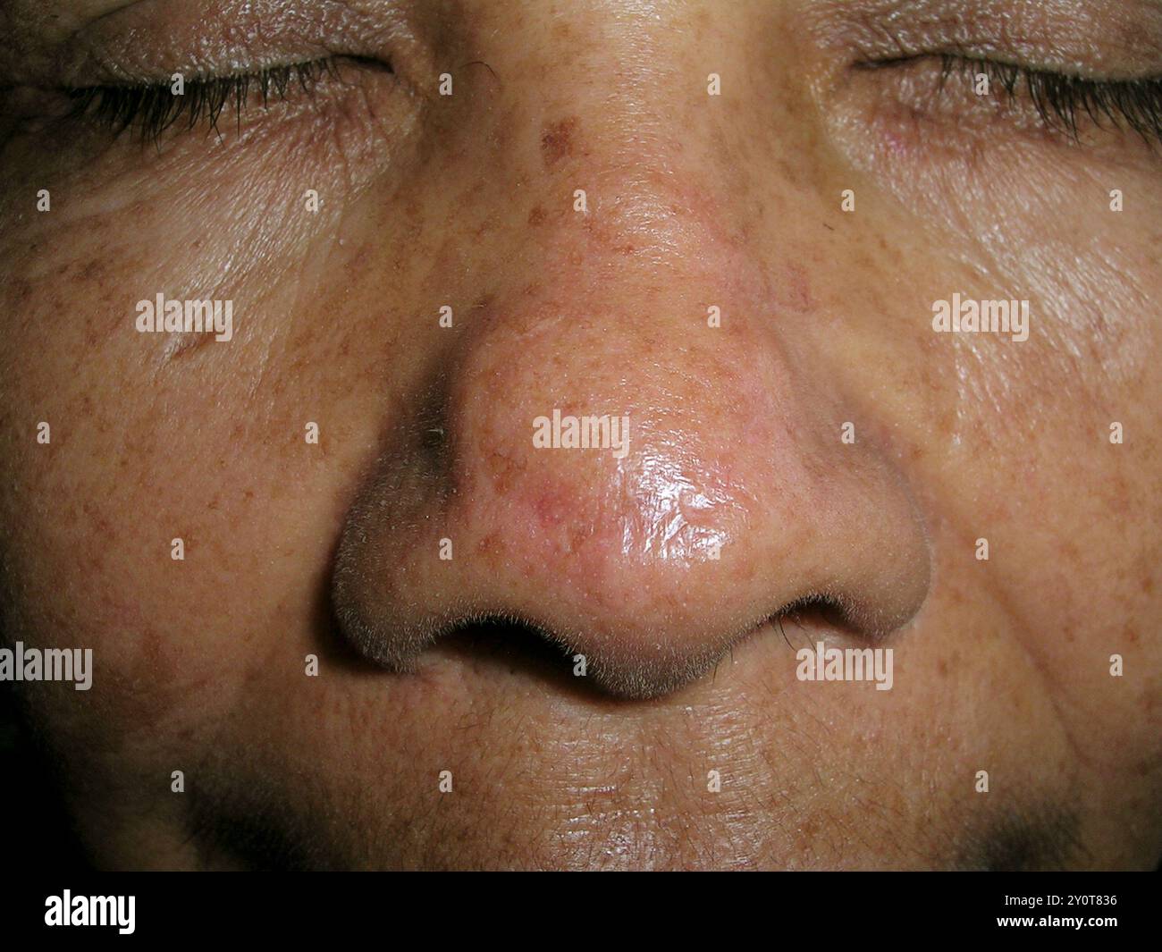 Patient's nose after the removal of a basal cell carcinoma (BCC), or ...