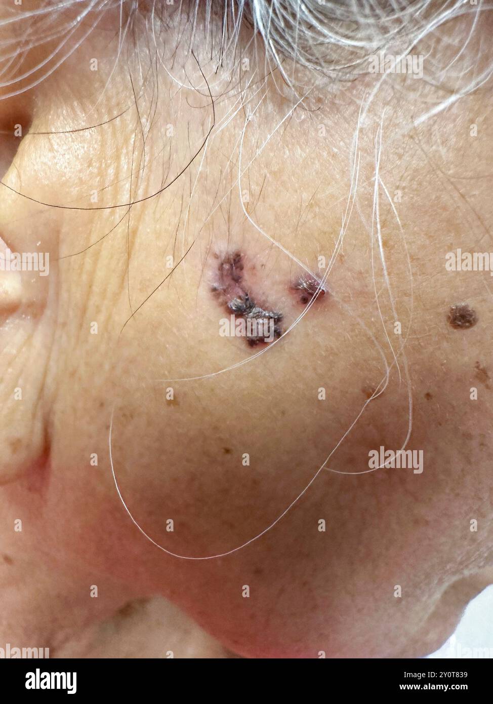 Pigmented basal cell carcinoma (BCC), or rodent ulcer, on a Hispanic ...