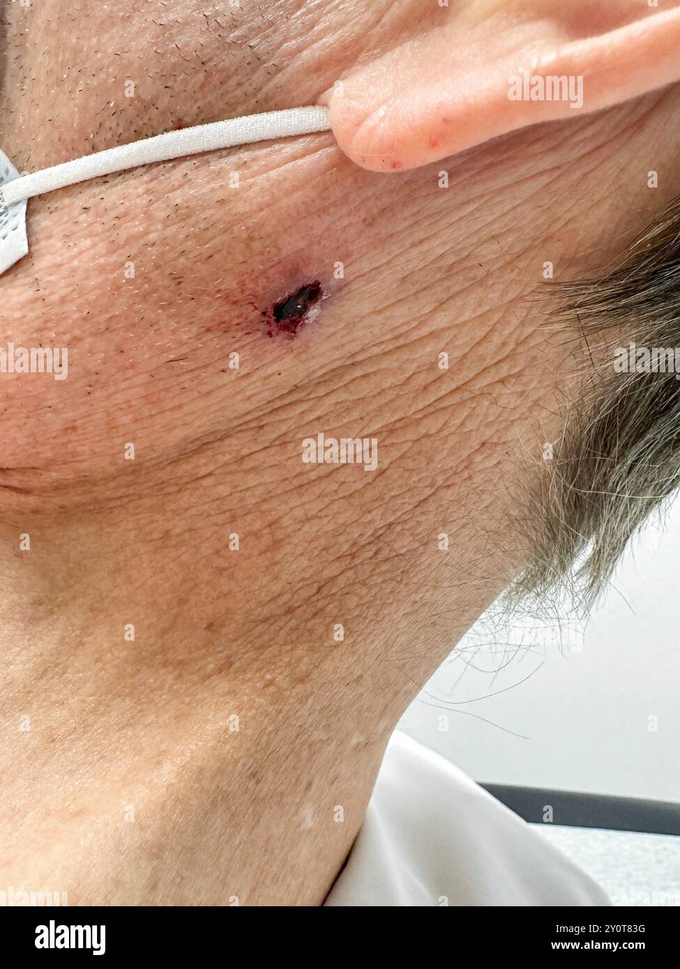 Nodular basal cell carcinoma (BCC), or rodent ulcer, beneath a patient ...