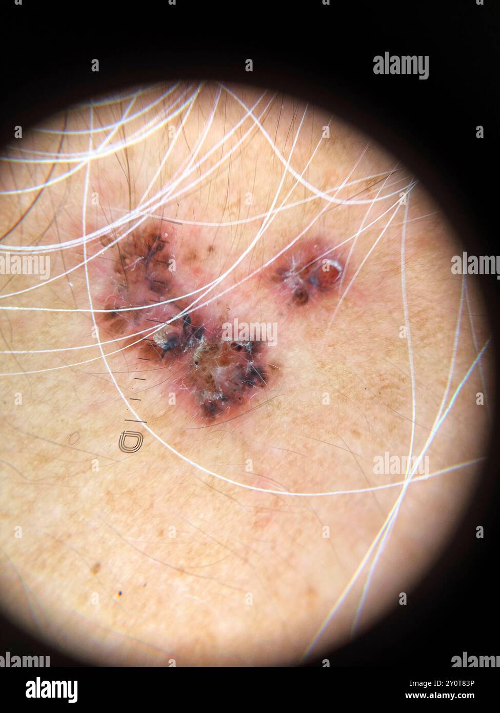 Dermatoscope image of of a pigmented basal cell carcinoma (BCC), or ...