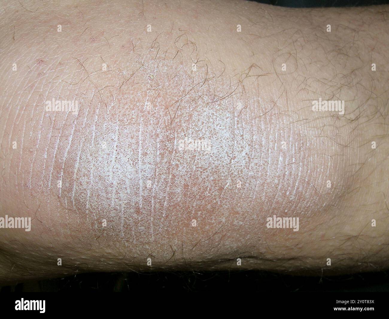 Psoriasis on a 60 year old white male patient's knee. Psoriasis is a ...