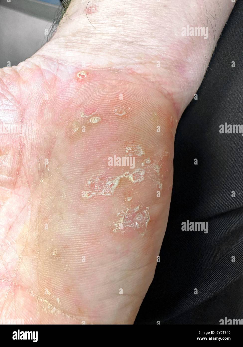 Palmoplantar psoriasis on the palm of a patient's hand. Psoriasis is a ...