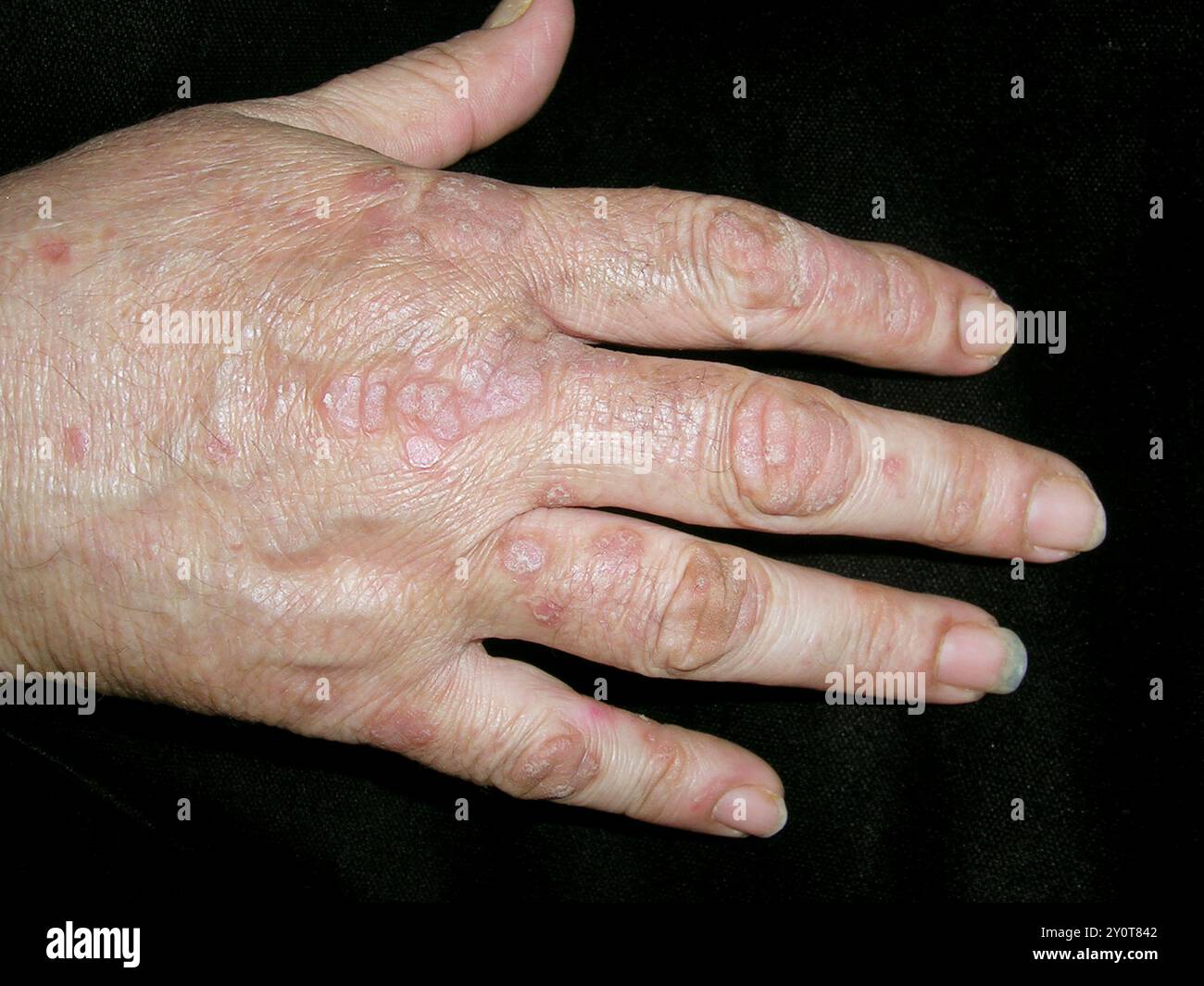 Psoriasis on a 53 year old Hispanic female patient's hand. Psoriasis is ...