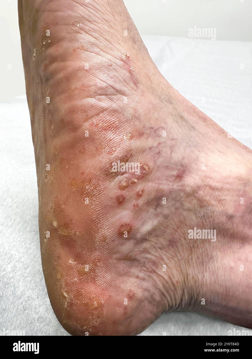 Palmoplantar psoriasis on a patient's foot. Psoriasis is a skin ...