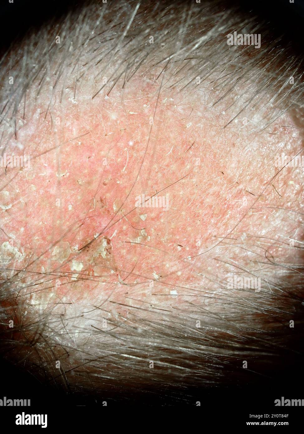 Dermatoscope image of a sebaceous naevus on the scalp of a 4 month old ...