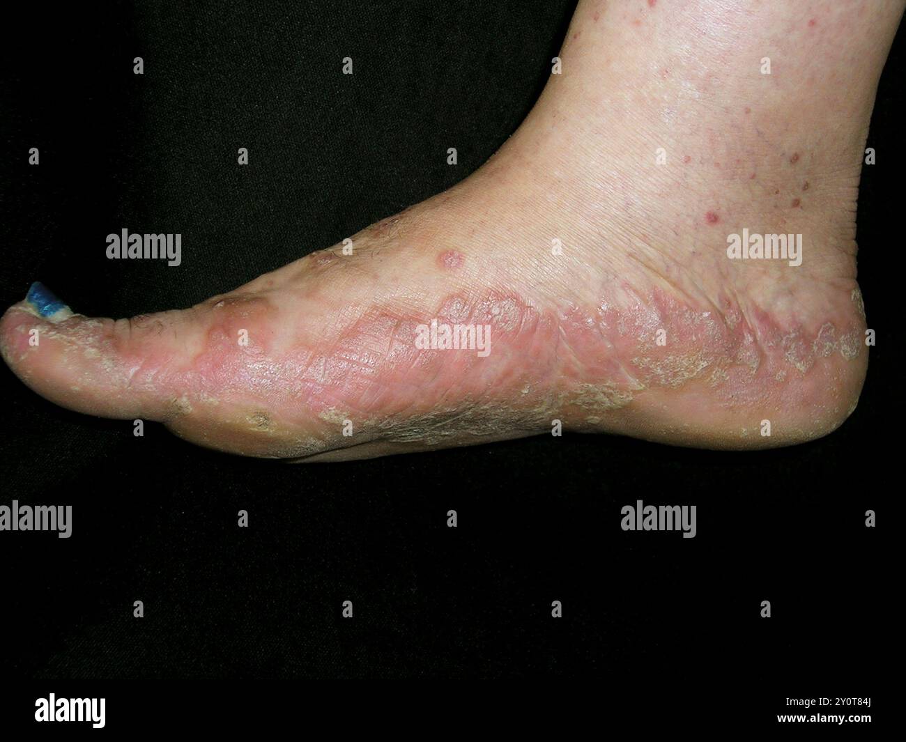 Psoriasis on a 53 year old Hispanic female patient's foot. Psoriasis is ...
