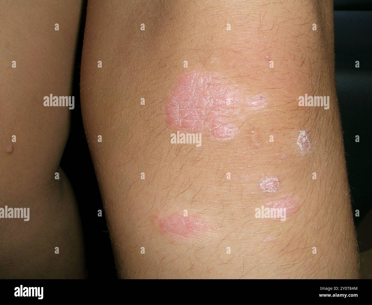Psoriasis on the arm of a seven year old Hispanic girl. Psoriasis is a ...