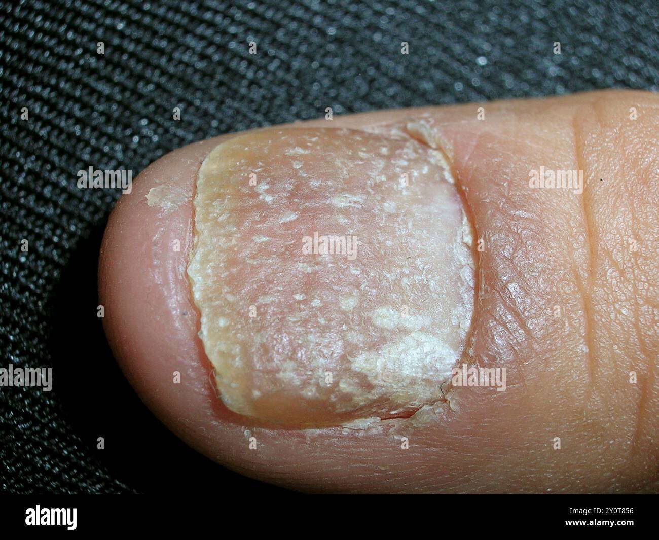 Psoriasis on the fingernail of a 10 year old Hispanic boy. Psoriasis is ...