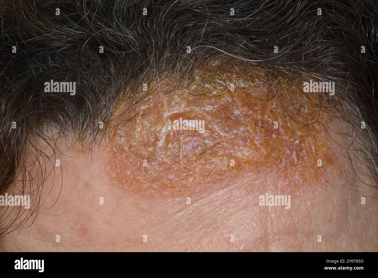 Scarring on the forehead of a 50 year old male patient after using ...