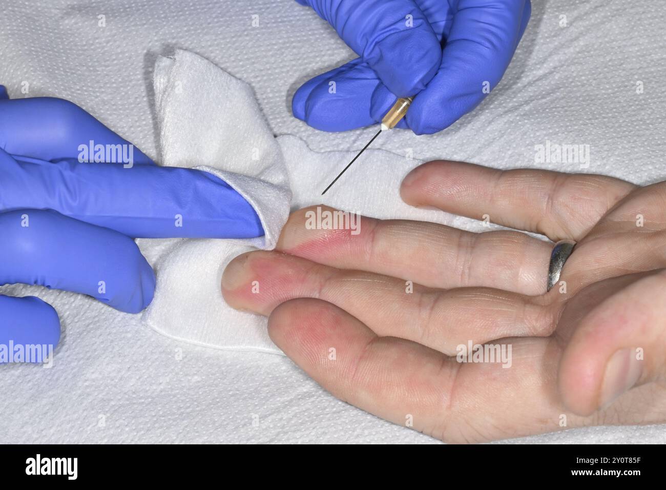 Burns from a hot plate on the fingers of a 40 year old male patient ...