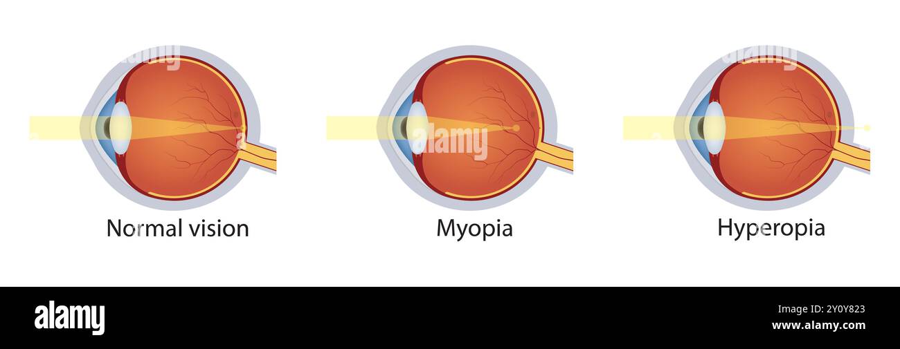 Normal vision, hyperopia, myopia. Set of vision disorders. Anatomy of ...