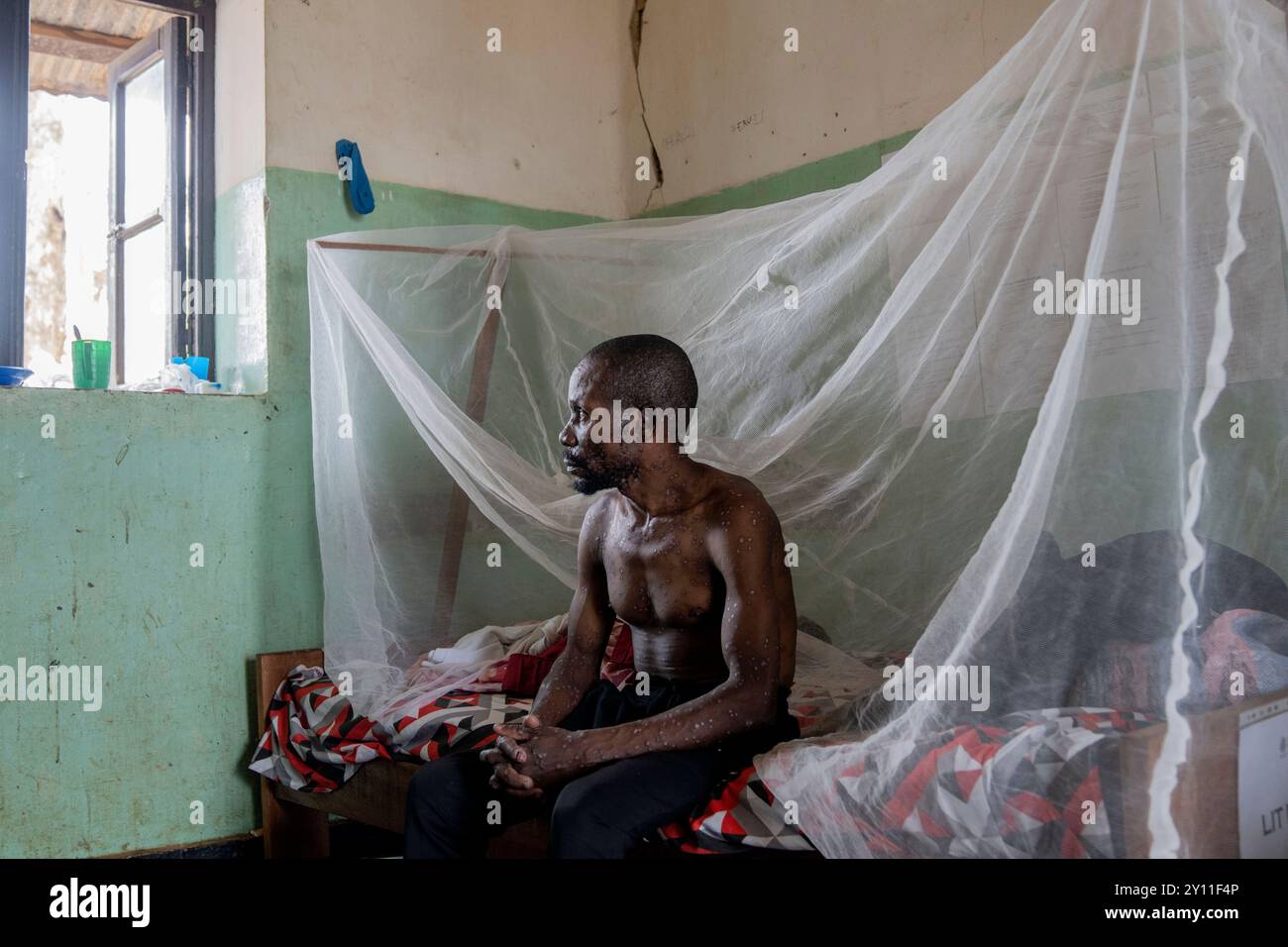 A man suffering from mpox poses for a photograph as he waits for ...