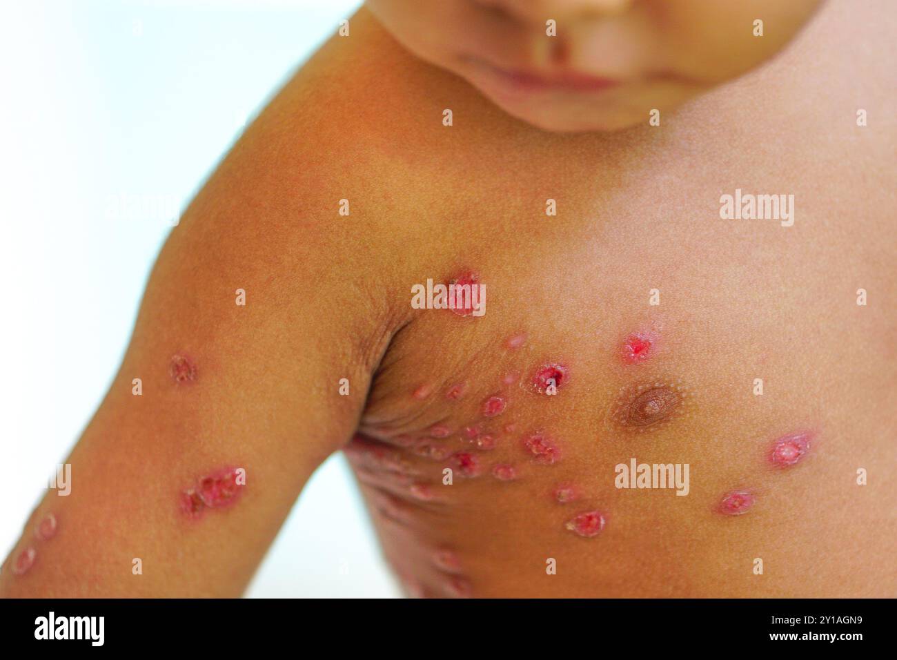 Monkeypox Virus on the skin of a baby isolated on a white background ...