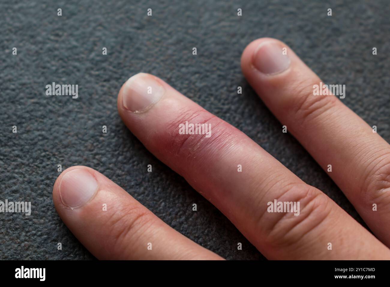 Mallet finger healing after splint removal from middle finger following ...