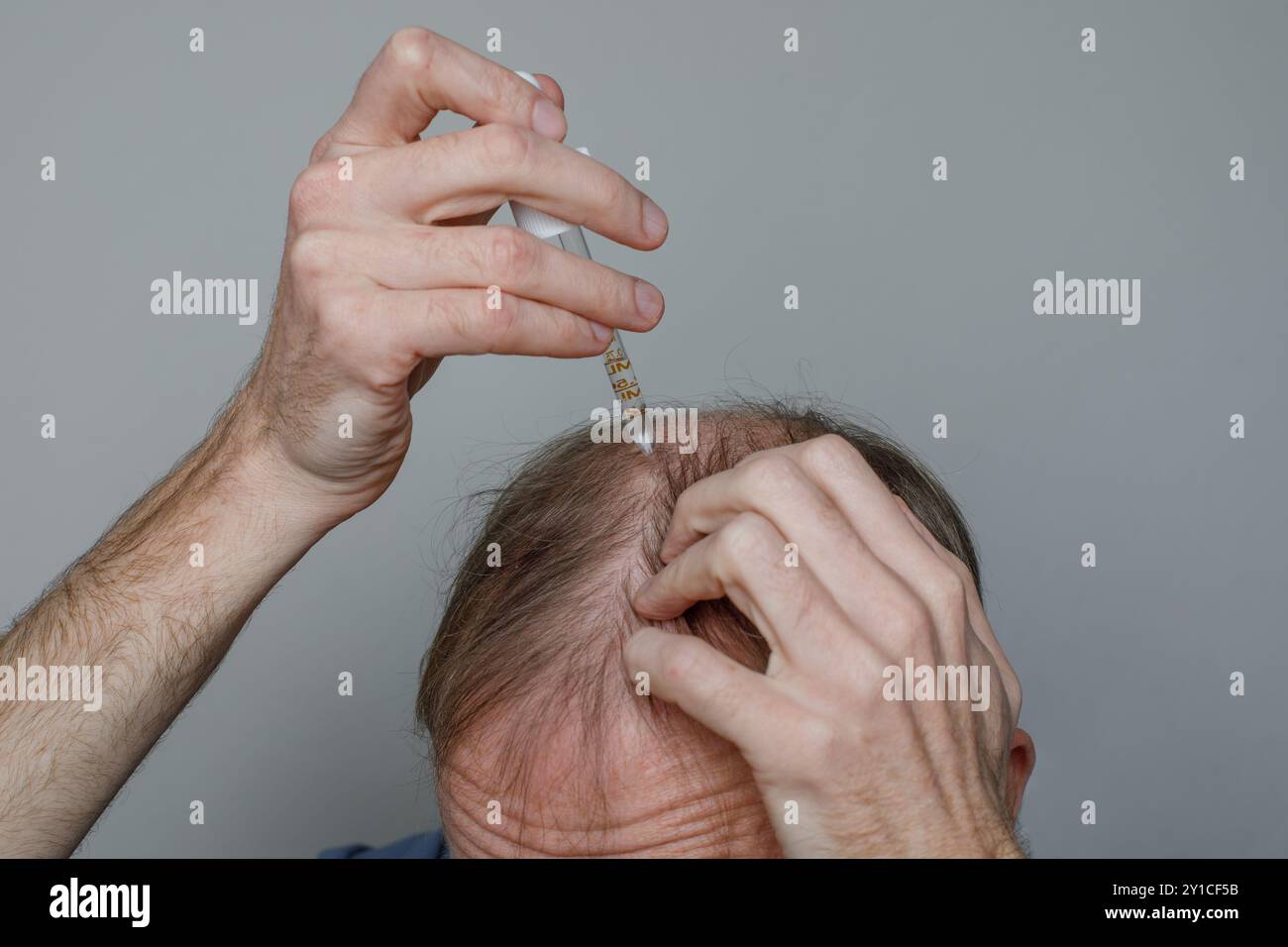Man suffering from hair loss using hair serum or minoxidil to treat ...