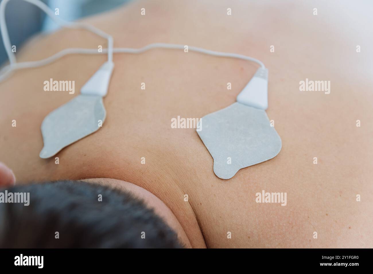 Electrotherapy session with electrodes for back pain relief in a ...