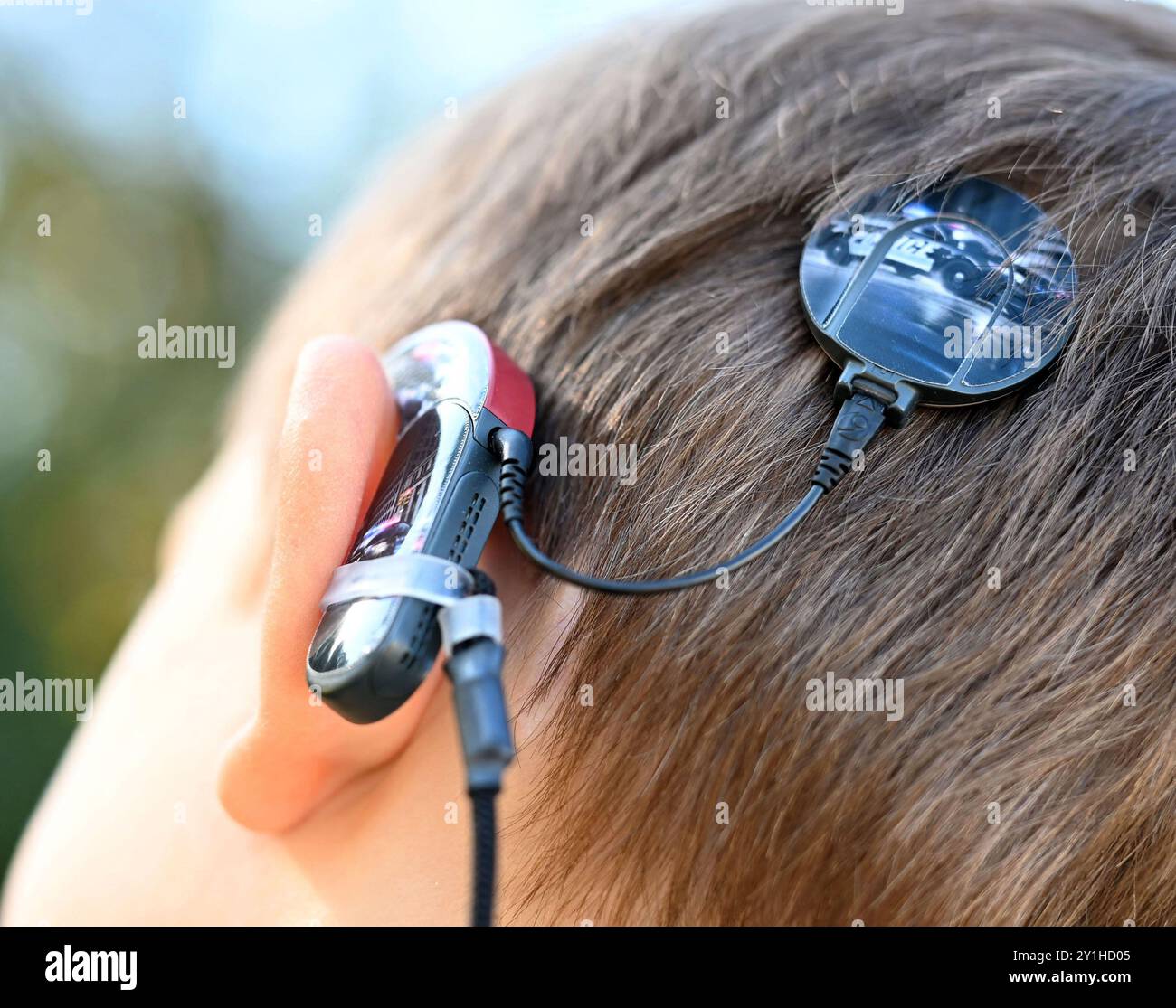 Karlsruhe, Germany. 07th Sep, 2024. A cochlear implant, a hearing ...