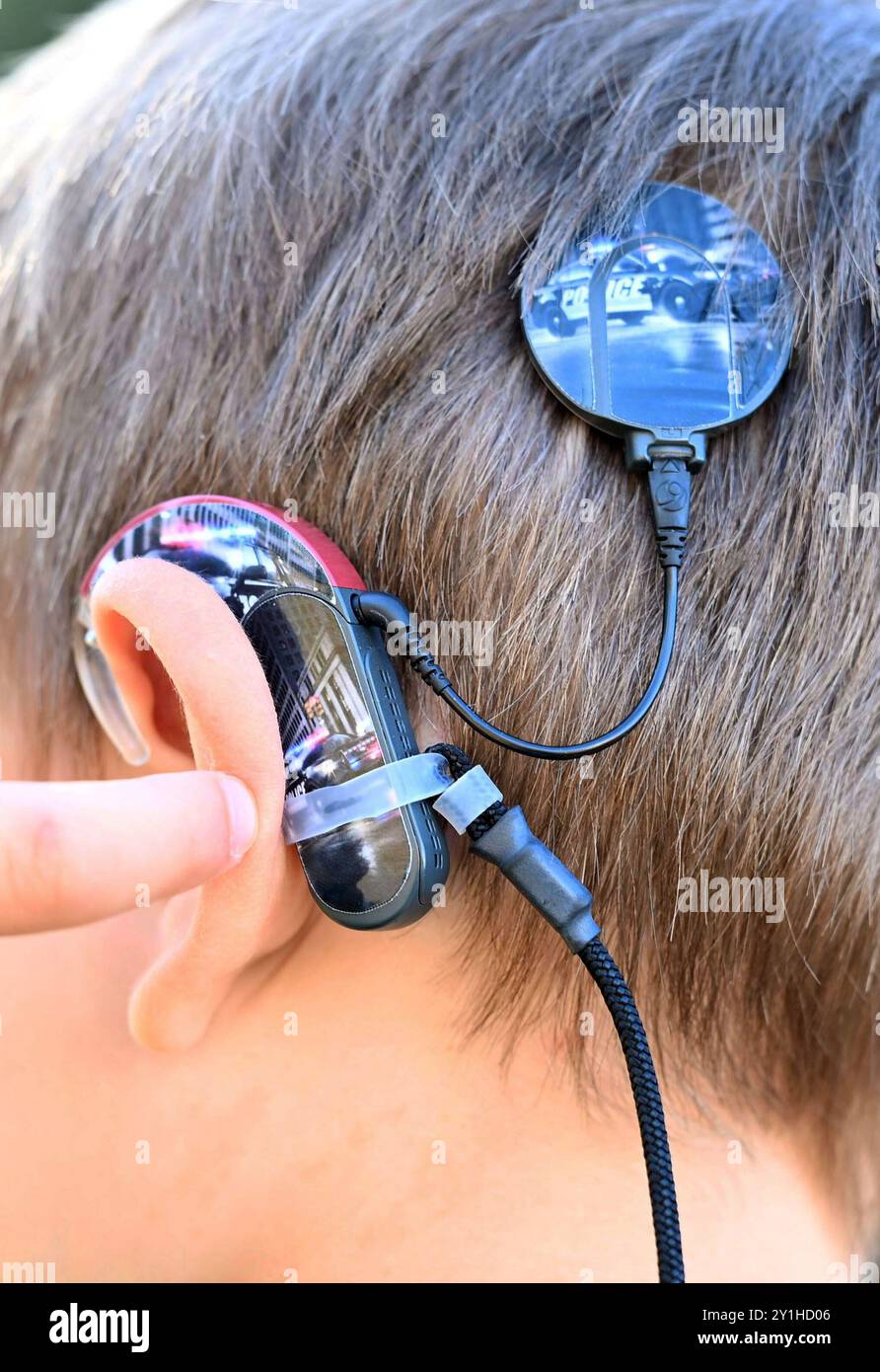Karlsruhe, Germany. 07th Sep, 2024. A cochlear implant, a hearing ...