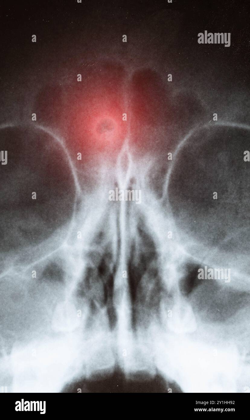 X-ray of sinusitis in a child. Inflammation of the nasal sinuses with ...